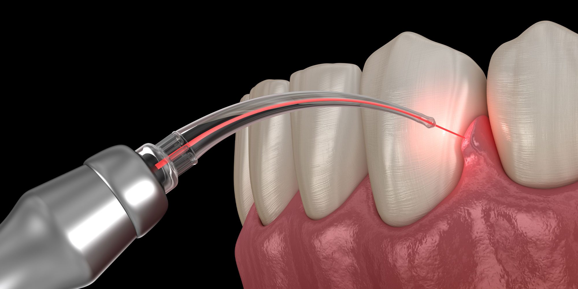 Laser Periodontics | Chicago, IL | Millennium Periodontics
